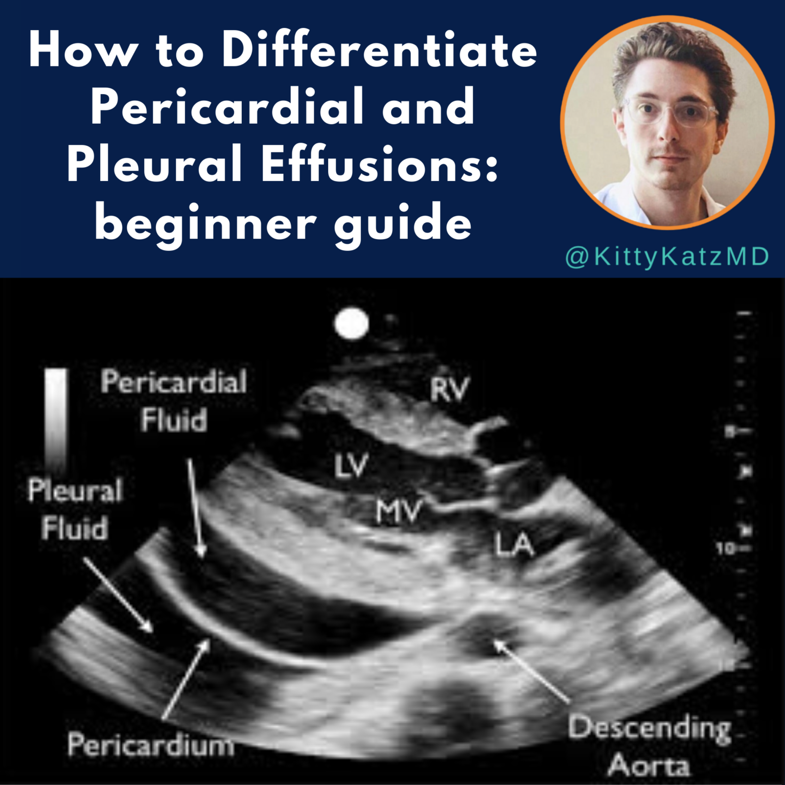 Pericardial and Pleural Effusions on US | Marc Katz MD