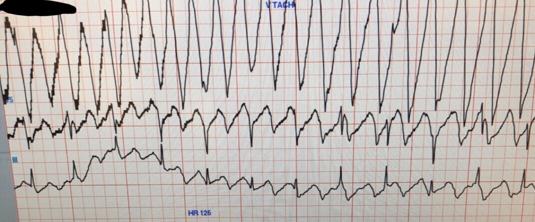 How To Interpret Inpatient Cardiac Telemetry | Marc Katz MD