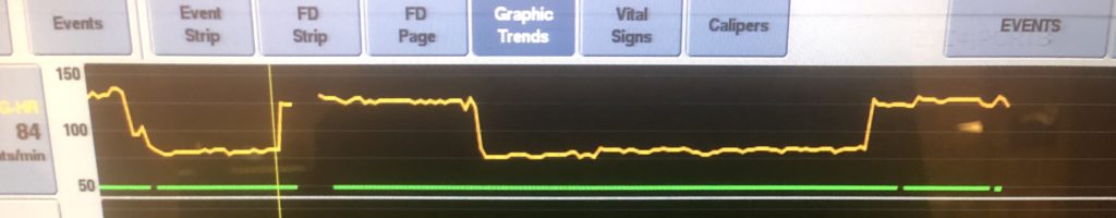 How To Interpret Inpatient Cardiac Telemetry | Marc Katz MD