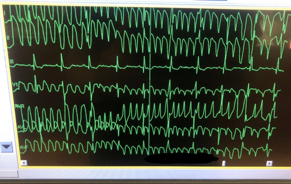How To Interpret Inpatient Cardiac Telemetry | Marc Katz MD