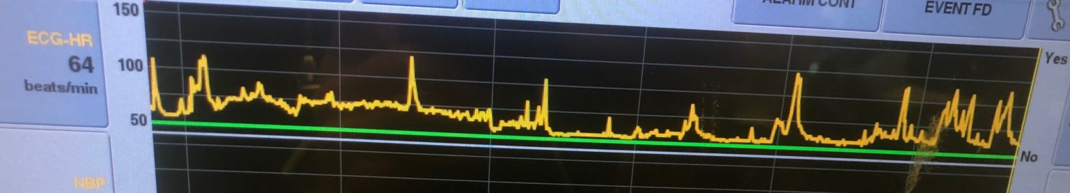 How To Interpret Inpatient Cardiac Telemetry | Marc Katz MD