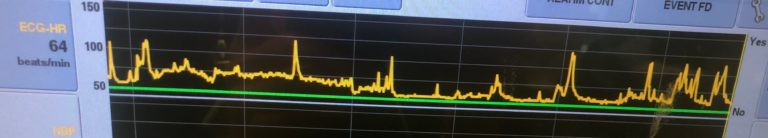 How To Interpret Inpatient Cardiac Telemetry | Marc Katz MD