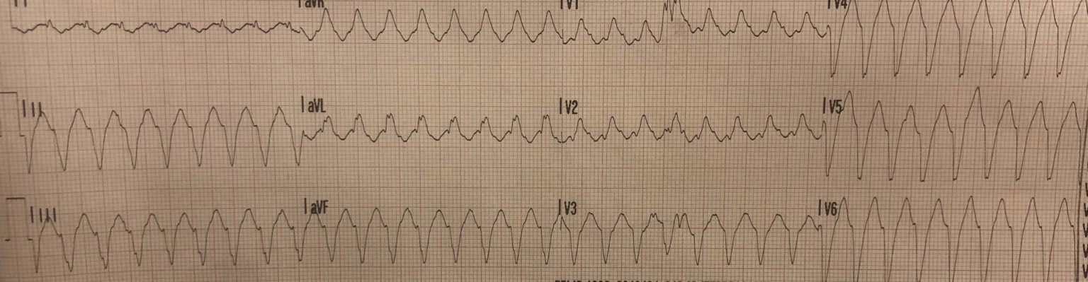 How To Interpret Inpatient Cardiac Telemetry | Marc Katz MD