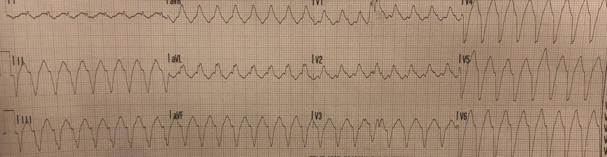How To Interpret Inpatient Cardiac Telemetry | Marc Katz MD