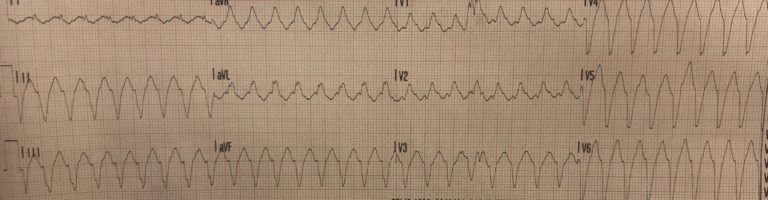How To Interpret Inpatient Cardiac Telemetry | Marc Katz MD