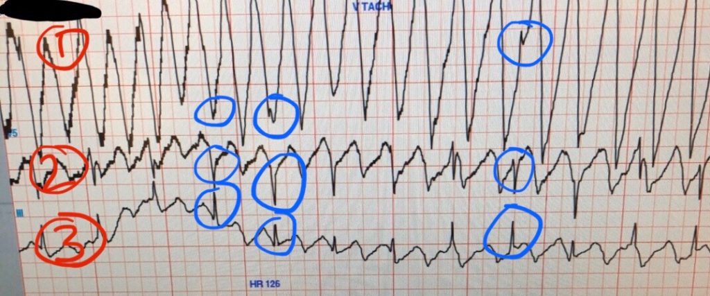 How To Interpret Inpatient Cardiac Telemetry | Marc Katz MD