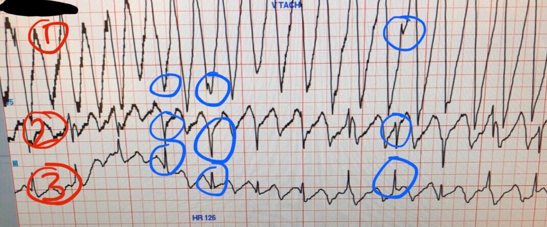 How To Interpret Inpatient Cardiac Telemetry | Marc Katz MD