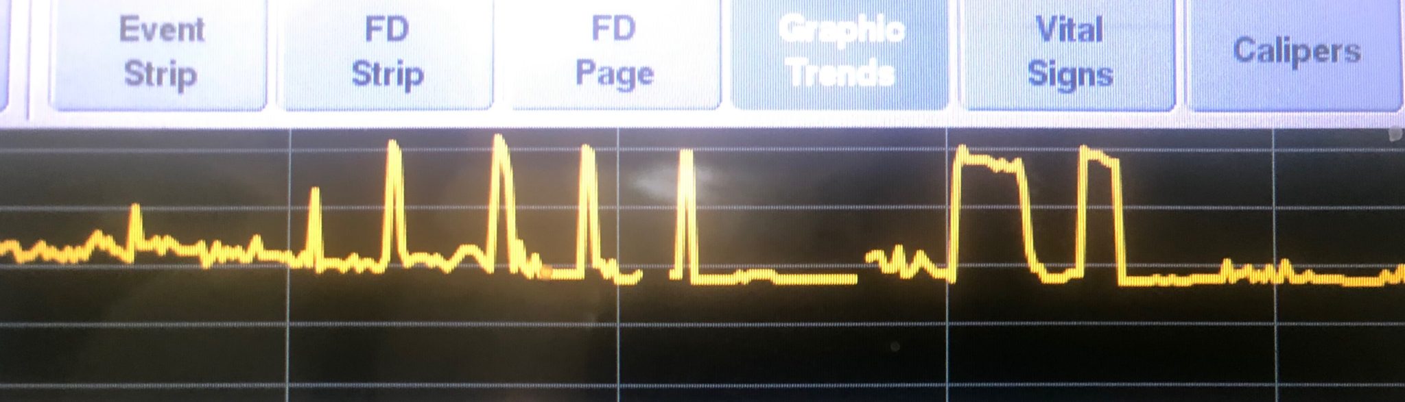 How To Interpret Inpatient Cardiac Telemetry | Marc Katz MD