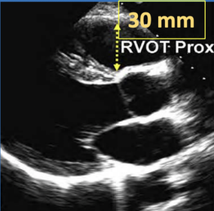 Echo Reference Values | Marc Katz MD