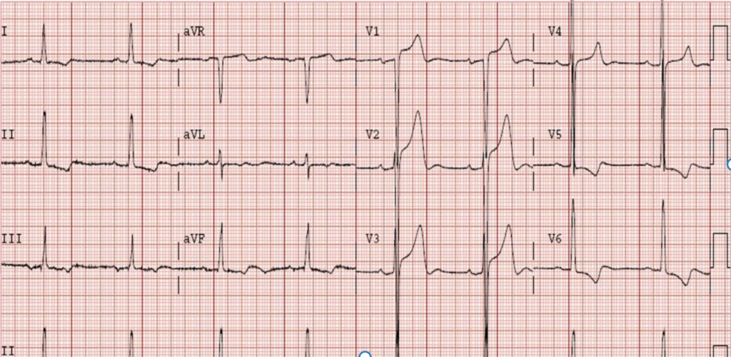 ECG Reference Guide For Medical Trainees | Marc Katz MD