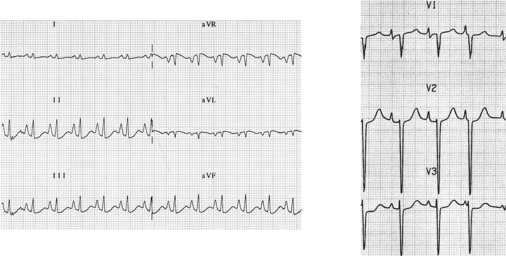 ECG Reference Guide For Medical Trainees | Marc Katz MD