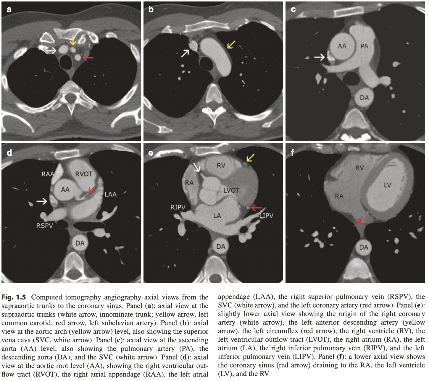Coronary CT for Cardiology Fellows | Marc Katz MD My notes on cardiac ...