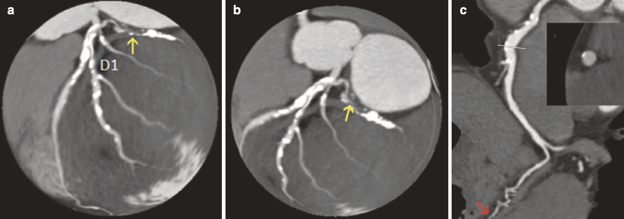 Coronary CT for Cardiology Fellows | Marc Katz MD My notes on cardiac ...
