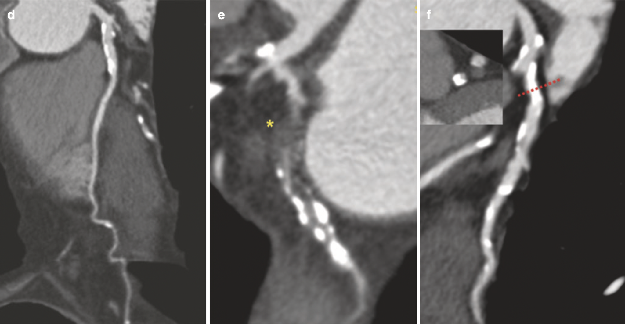 Coronary CT for Cardiology Fellows | Marc Katz MD My notes on cardiac ...